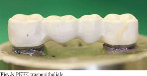 Figure 3 From Behavior Of Polyether Ether Ketone Peek In Prostheses