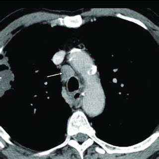 Contrast Enhanced CT Of The Chest Of A 51 Year Old Male With Invasive