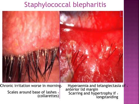 Ppt Blepharitis Types Diagnosis And Managment Powerpoint Presentation
