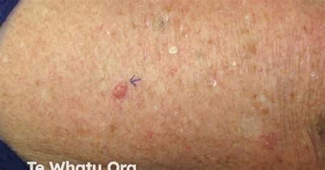 Dermnet® Nodular Basal Cell Carcinoma Arm Image