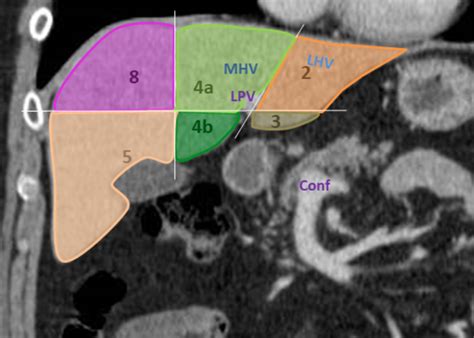 Radiopaedia Ct Scan Hepatic Segments Coronal Section Labels