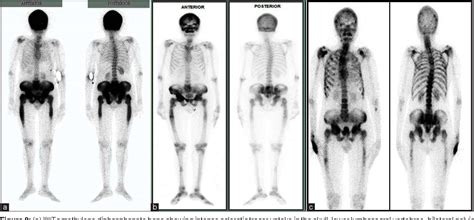Figure 2 From An Unusual Presentation Of Metastatic Bone Disease In A