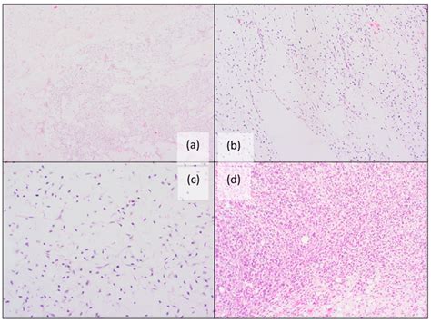 Histopathological Features Of Myxoid Liposarcoma A Characteristic