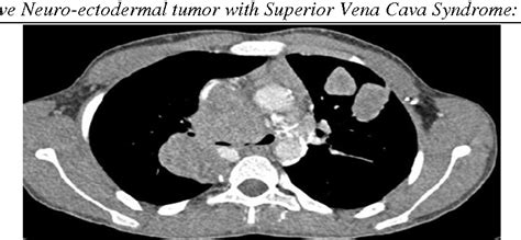 Figure 1 From Thoracic Primitive Neuro Ectodermal Tumor With Superior Vena Cava Syndrome A