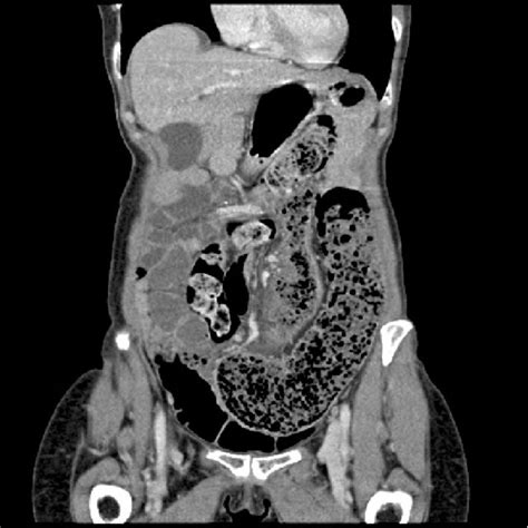 Pdf Transverse Sigmoid Colon Knot A Rare Cause Of Bowel Obstruction