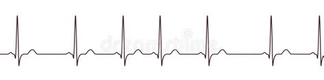 Respiratory Sinus Arrhythmia Is Shown With Heart Lungs And Ecg