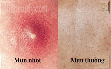 Mụn Nhọt Ở Lưng Là Bệnh Gì Cách Điều Trị Dứt Điểm