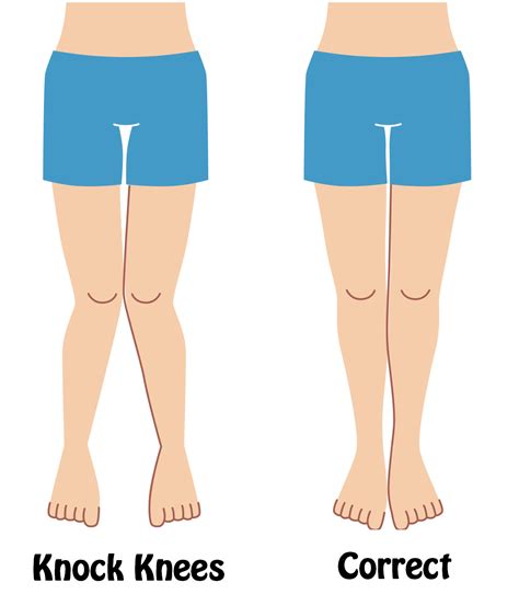 What Causes Knock Knees In Elderly At Janice Hogan Blog