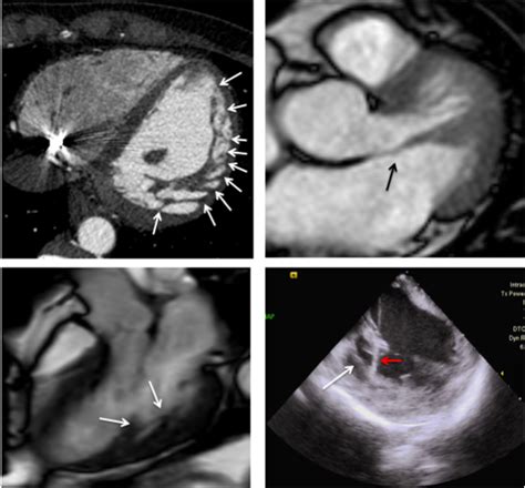 Implications Of The Anatomy Of Papillary Muscle Connections For Mapping