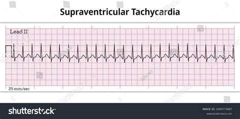 Ventricular Tachycardia
