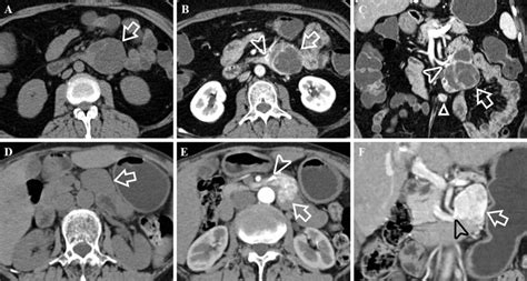 62 Year Old Female With A G1 Dnen Axial Image In The Unenhanced Phase