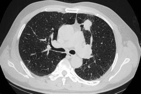 Expert Perspectives Diagnostic And Prognostic Biomarkers For Chronic Fibrosing Interstitial