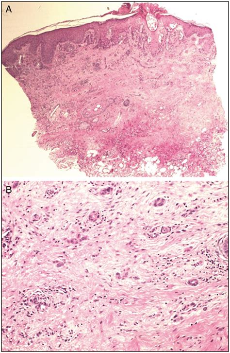 Mohs Surgery For Squamoid Eccrine Ductal Carcinoma Jcas