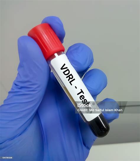 Tabung Sampel Darah Untuk Tes Vdrl Diagnosis Untuk Infeksi Sifilis Foto
