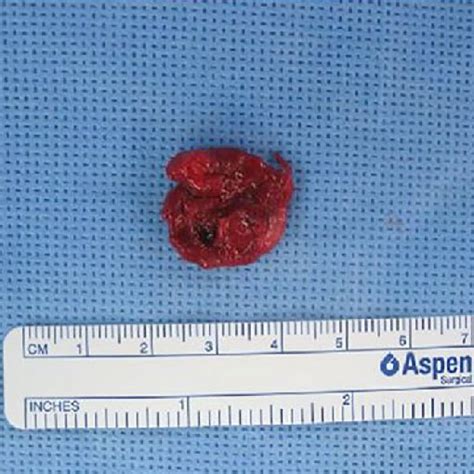 Cross Sectional View Of The Removed Cyst An Approximately 2 Cm 3