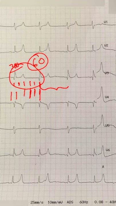 Hyperkalemia Peaked T Waves And Ecg Recognition Youtube