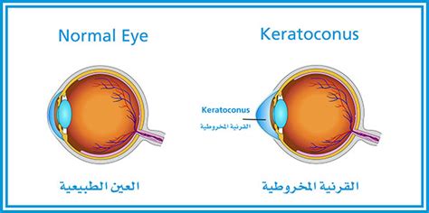 What Is Keratoconus Symptoms And Treatment