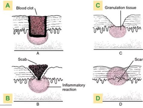 L10 Wound Healing Flashcards Quizlet