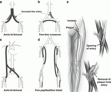 Arterial Ulcer Basicmedical Key