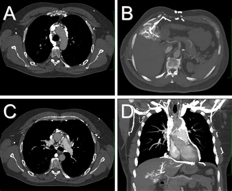 Svc Occlusion With Portal Vein Collaterals
