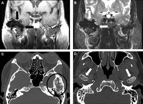 Chondroid Synoviocytic Neoplasm A Clinicopathologic Immunohistochemical And Molecular Genetic