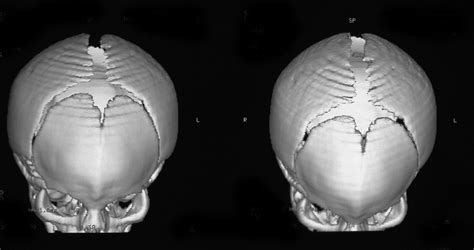 Metopic Synostosis Facts And Photos Nexus Neurosurgery