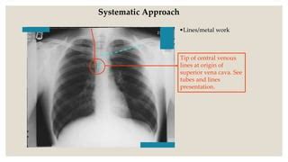 Chest X Raypptx