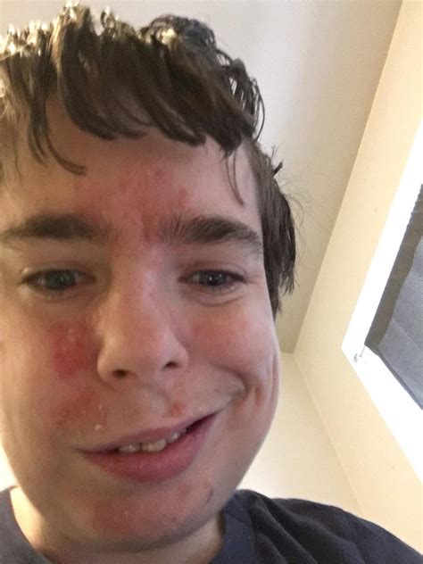 Face Reveal Dont Mind The Rash It Comes And Goes And Were Not Sure