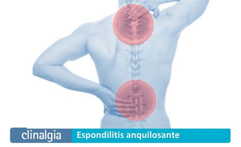 Espondilitis Anquilosante Síntomas y Tratamiento