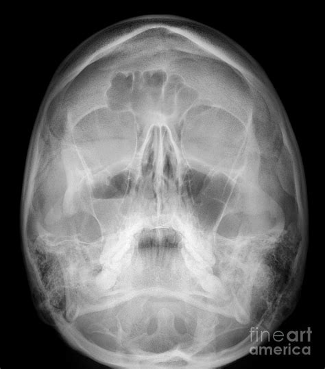 Facial Fractures X Ray Photograph By Science Photo Library Fine Art