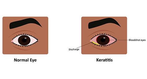 130 Blefaritis Ilustrasi Grafik Vektor And Clip Art Bebas Royalti