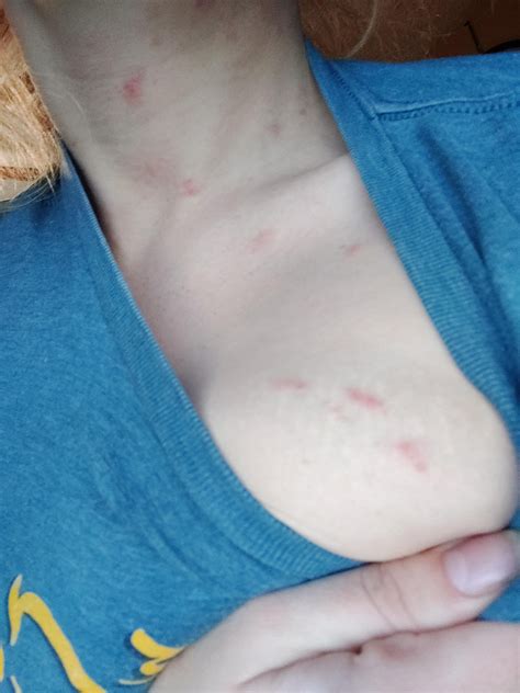 Poison Ivy Vs Scabies Backstory In Comments Rscabies