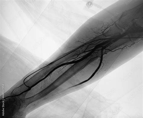 The Preoperative Evaluation Consisted Of Angiogram Of The Radial Artery