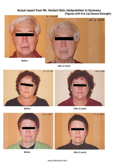 Measuring Lipclosure Strength Lip Trainer Patakara