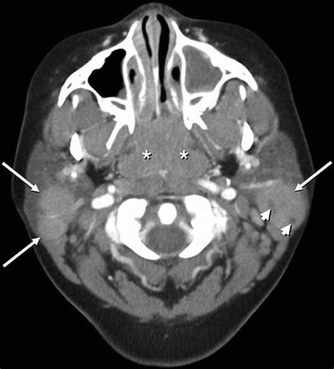 Benign Lymphoepithelial Lesion