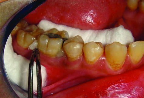 Measurement Of Mean Of Interproximal Bone Loss Using Sidexis 4 Software Download Scientific