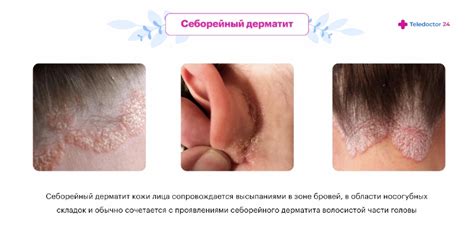 Себорейный дерматит что такое себорея причины виды осложнения диагностика лечение