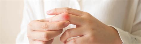 Scleroderma And Lupus Kaleidoscope Fighting Lupus