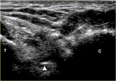 The Radiology Assistant Us Guided Injection Of Joints