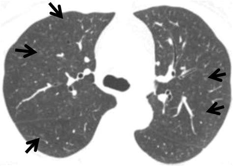 Interstitial Lung Abnormalities At Ct Subtypes Clinical Significance And Associations With