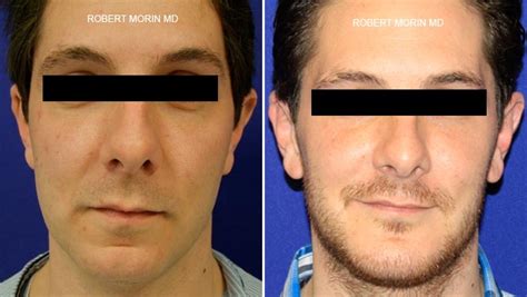 Chin Surgery Photo Gallery Nyc Genioplasty Hackensack Nj