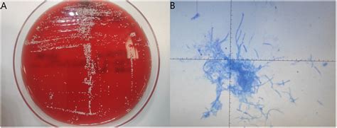 Linfangitis Causada Por Nocardia Brasiliensis Tras Picadura De Mosquito