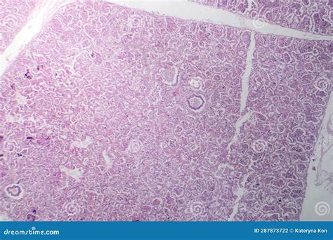 Lobar Pneumonia In Red Hepatic Phase Light Micrograph Royalty Free