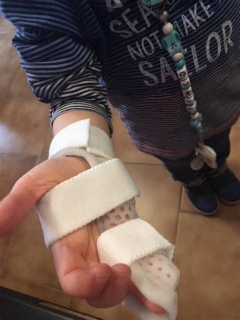 Orthèse Pédiatrique Pour Fracture Du Cinquième Os Métacarpien