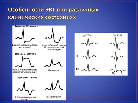 Расшифровка ЭКГ - презентация онлайн