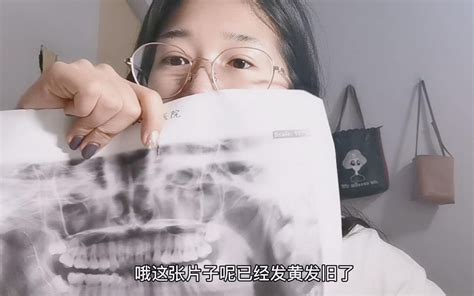 整牙两年前后对比图，牙齿是人的第二张脸，绝对值了！！哔哩哔哩bilibili