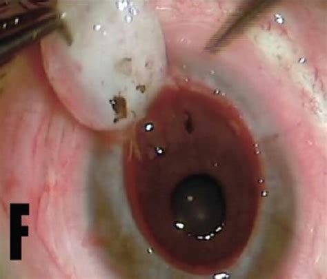A Slit Lamp Photo Of Case 5 At 1st Visit Showing Ciliary Injection