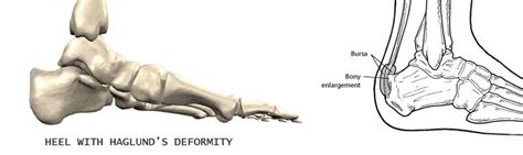 Haglunds Deformity Manly Foot Clinic