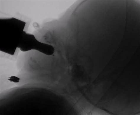 Foundational Information Pediatric Dysphagia And Feeding Disorders