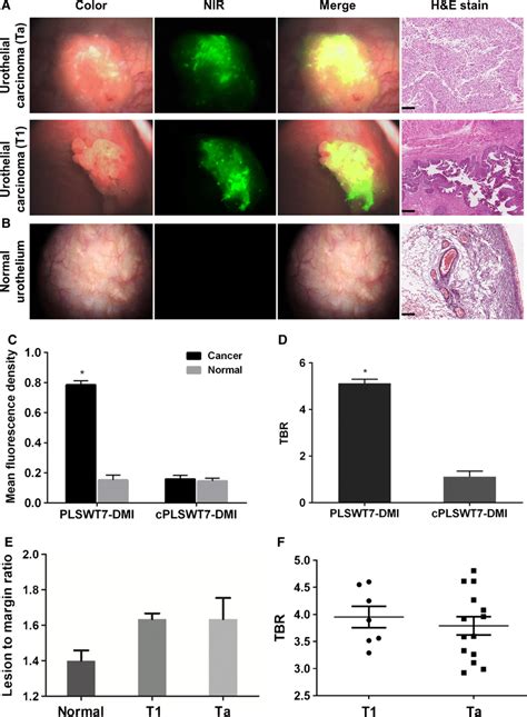 Nir Fluorescence Endoscopy Of Nimbc In Humans With The Tumor Specific